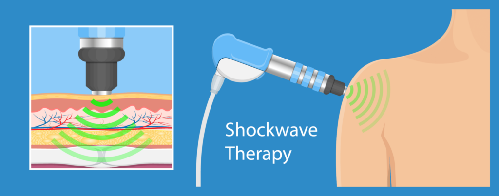 Shockwave Therapy Treatment - Seven Bridges Chiropractic